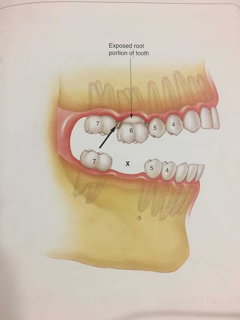 Single Missing Tooth Replacement in South Delhi