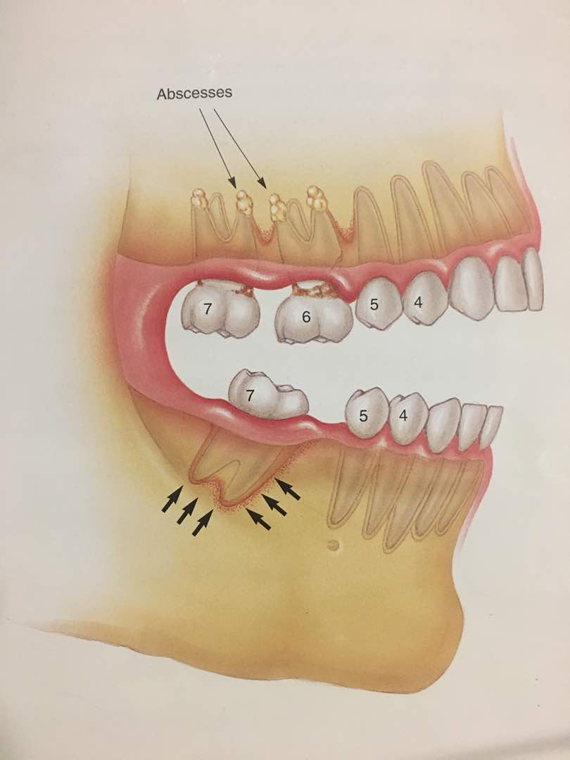 Single Missing Tooth Replacement in South Delhi