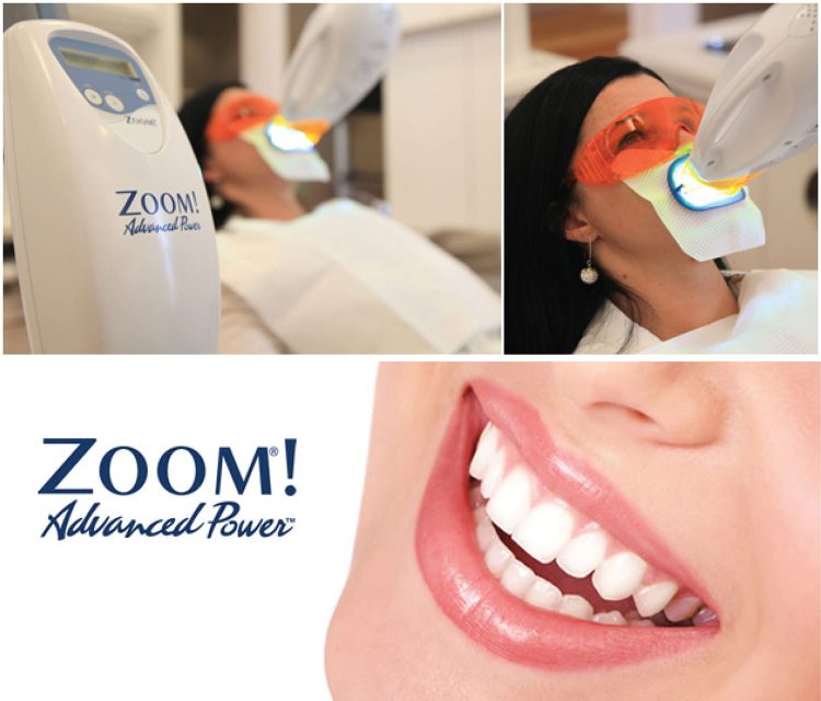 Professional Teeth Whitening vs. OTC Options: Which is Better? Professional Teeth Whitening vs. OTC Options: Which is Better?