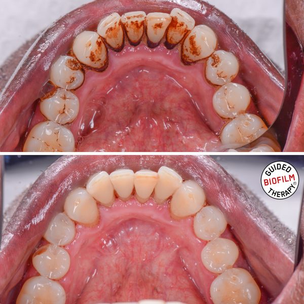 Myths About Teeth Scaling | Smile Delhi - The Dental Clinic